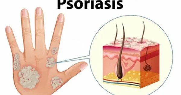 Le Psoriasis : Plus qu'une Affection Cutanée, une Lutte au Quotidien